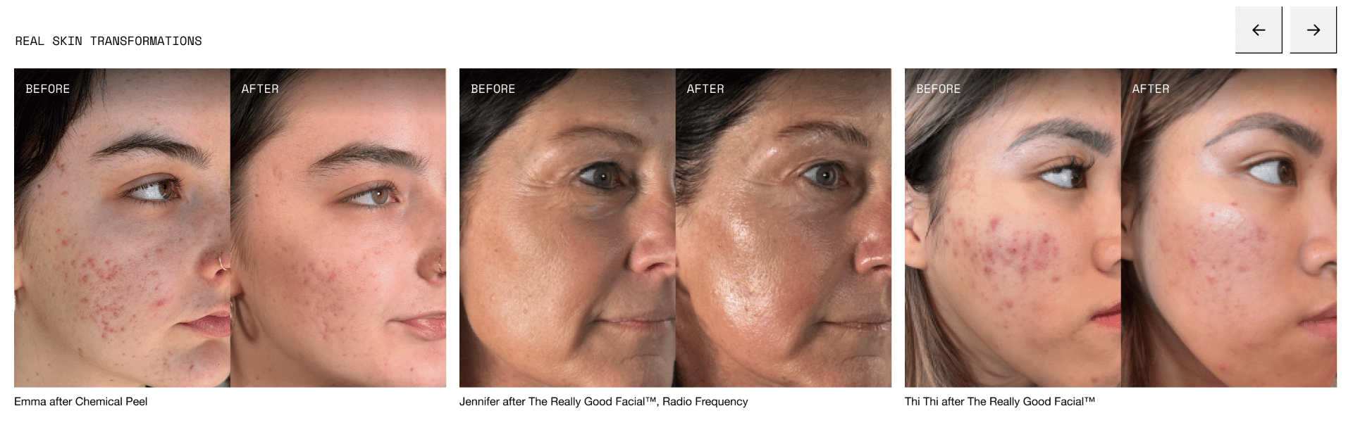 Hi, skin Reviews & Skin Transformations